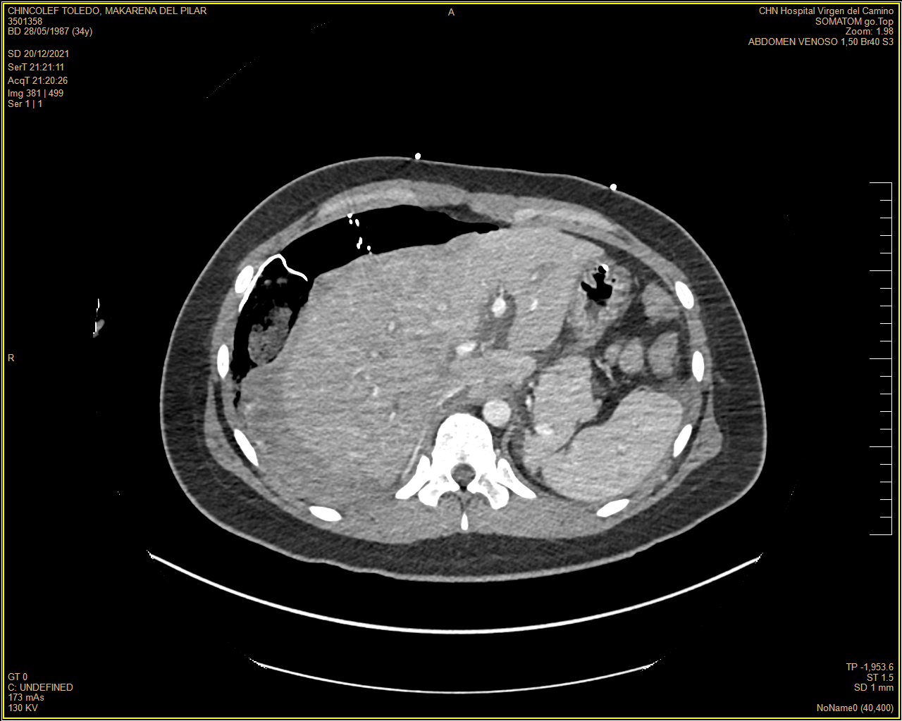 Surgical management of spontaneous hepatic rupture associated with ...