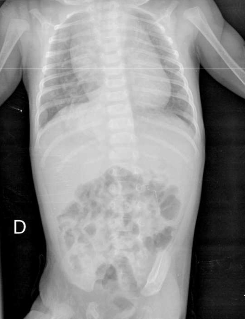 A Late And Unusual Diagnosis Of Intrathoracic Stomach