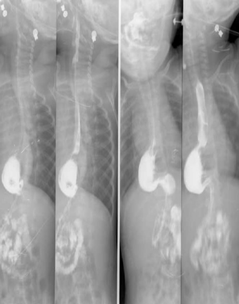 A Late And Unusual Diagnosis Of Intrathoracic Stomach
