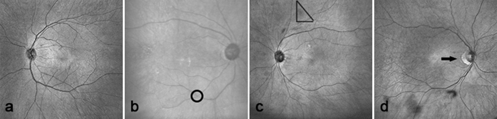 Association of fundus damage, renal function deterioration, and ...