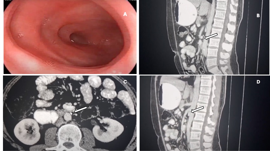 Superior mesenteric vein syndrome: A rare cause of duodenal obstruction ...